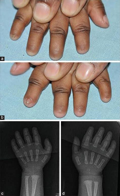 Anonychia With Absent Phalanges And Brachydactyly Medizzy