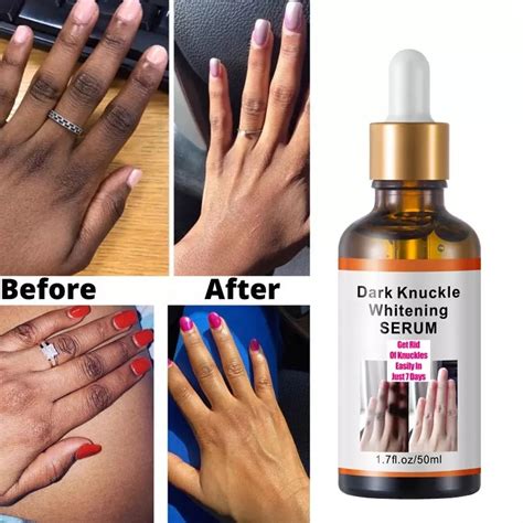 Black Friday Discounts For Elbows Knees Knuckles Remover Whitening
