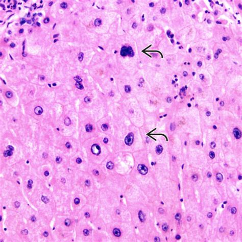 Regenerative And Dysplastic Nodules Basicmedical Key