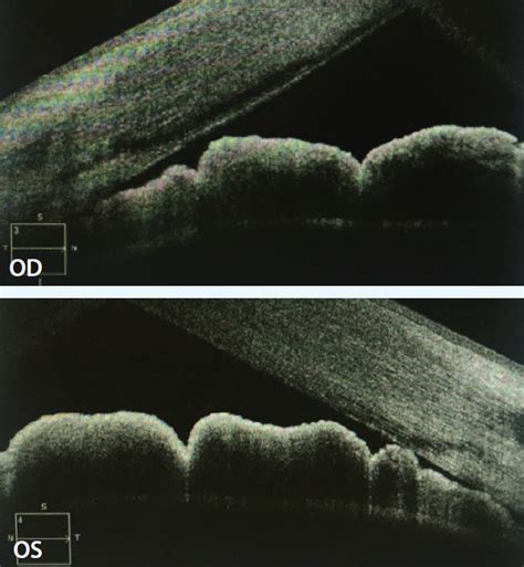 A Case Of Ciliary Body Cysts Glaucoma Today