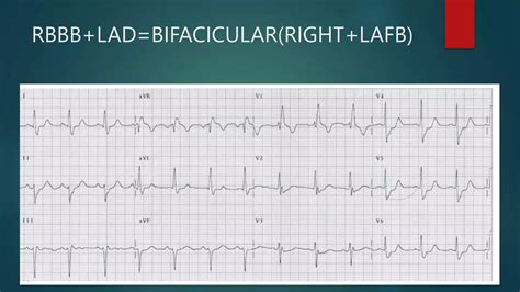 Differentials Of Arrythmias With Rbbb Morphology Pptx