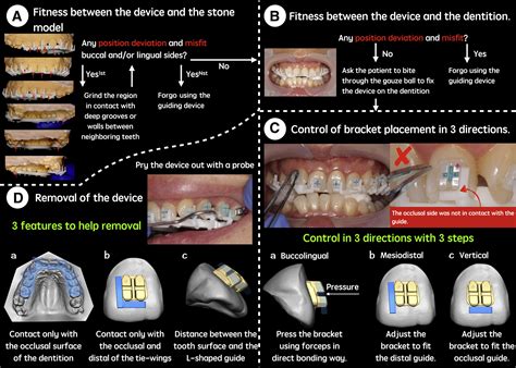 Orthodontic Bracket Positioning At Alberto Stark Blog