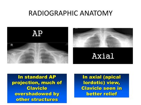 Ppt The Controversial Clavicle Powerpoint Presentation Free Download