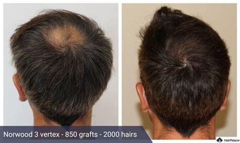 Crown Hair Transplant Is It A Good Idea