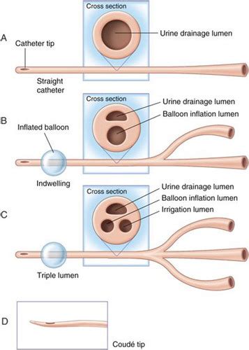 Indwelling Catheter Vs Intermittent
