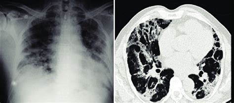 A Chest X Ray Posteroanterior View At Discharge Shows Bilateral