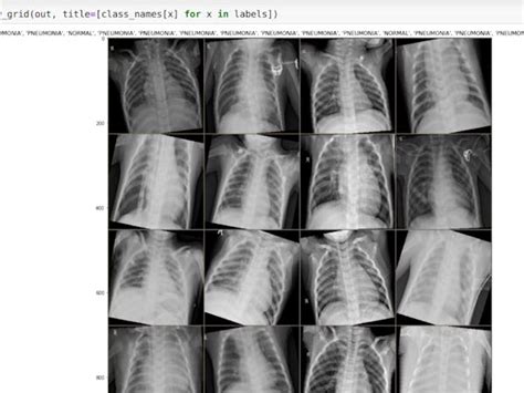 Pneumonia Classification Using Pytorch