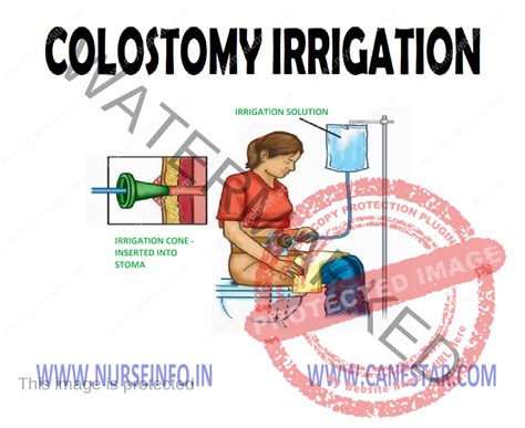 Colostomy Irrigation Nurse Info