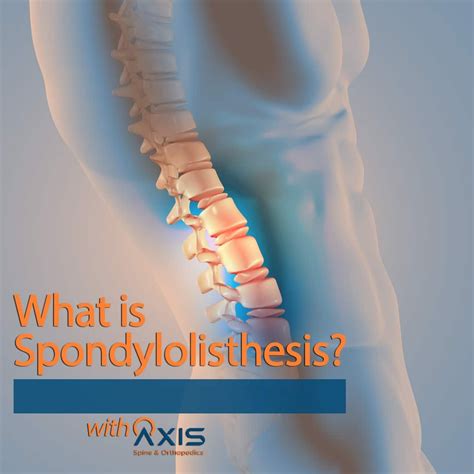 What Is Spondylolisthesis Axis Spine And Orthopedics