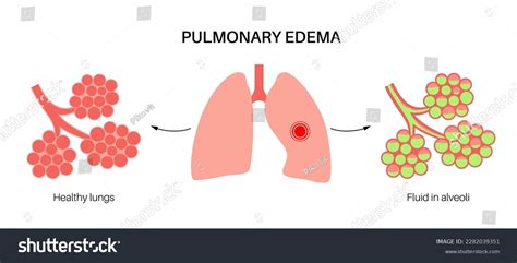 Pulmonary Edema Diagram