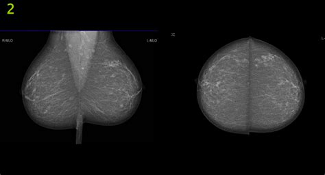 Mammography Pgmi Evaluation Hi Can I Get Help