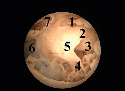 Middle Ear In A Left Dry Temporal Bone 1 Stapes 2 Subiculum 3 Download Scientific Diagram