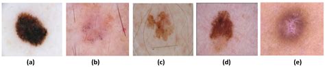 Advanced Deep Learning Models For Melanoma Diagnosis In Computer Aided