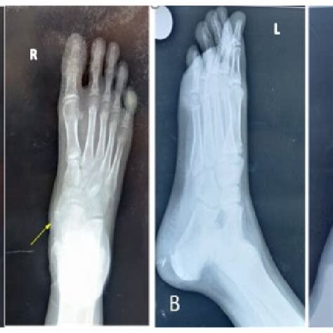 Wibergs Classification Of Patella Download Scientific Diagram