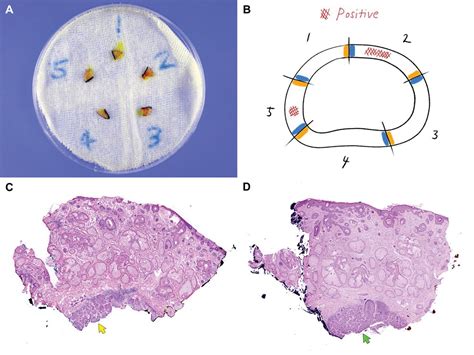 Clinicopathological Factors Influencing Resection Margin Involvement
