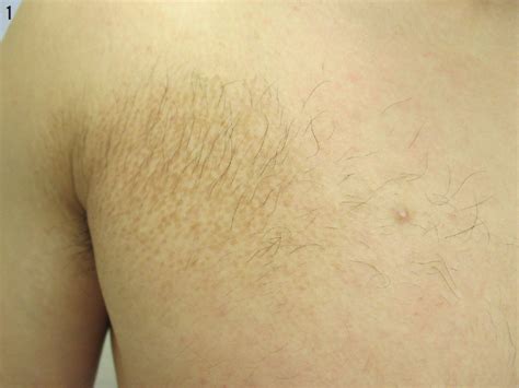 Hyperpigmentation On Back