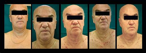 Cetuximab Related Acneiform Rash In A Patient Following Prophylactic Download Scientific