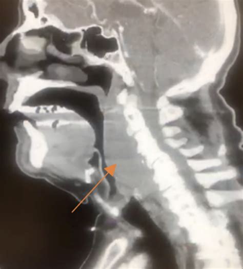 Retropharyngeal Abscess Diagnosis Em Board Bombs Podcast