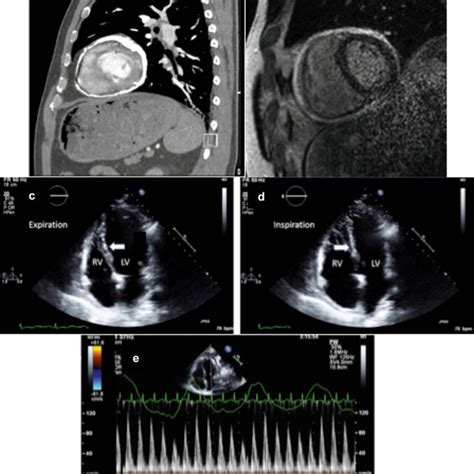 Cardiovascular Imaging Findings Of Constrictive Pericarditis A Cardiac