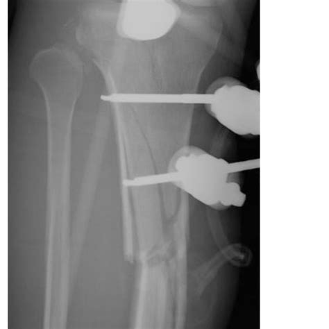 Pdf Masquelet Reconstruction Distal Femoral Segmental Defect After 3a Open Fracture