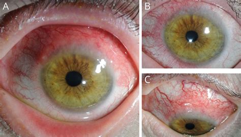 Limbic Sparing Conjunctivitis