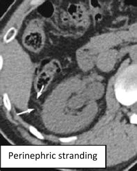 An Axial Image Of Uhct Showing Perinephric Stranding Download