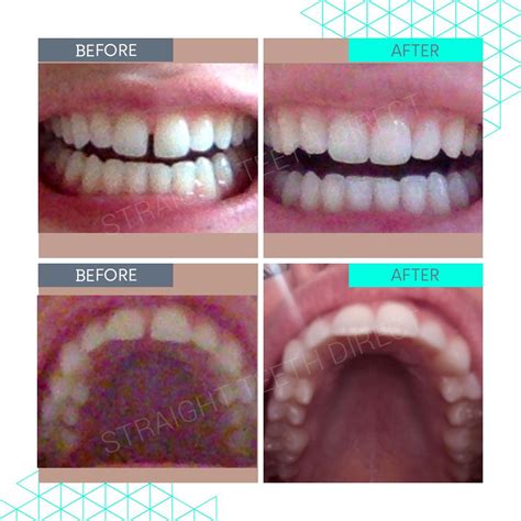 Invisible Teeth Braces At Home Teeth Straightening Made Simple