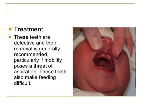 Anomalies Of Tooth Formation And Eruption
