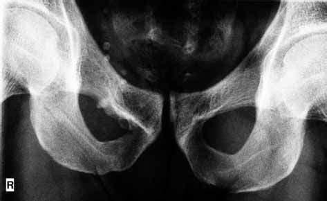 B — Case 5 Osteitis Pubis Mri T1 Weighted Transverse Images After