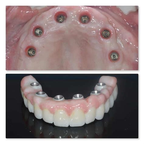 Individual Implants To Replace A Full Set Of Teeth