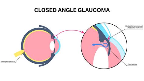 Comprehensive Care For Acute Closed Angle Glaucoma In London