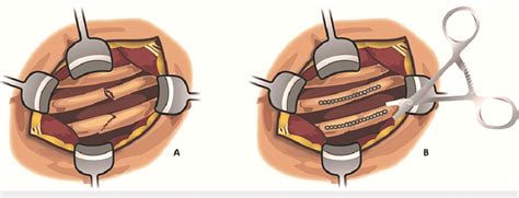 Illustrations Displaying Multiple Rib Fractures Before A And After