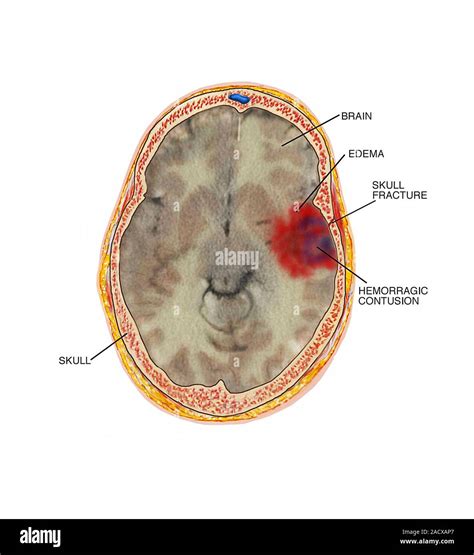 Brain Internal Bleeding
