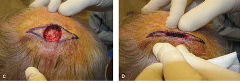 Scalp Plastic Surgery Key