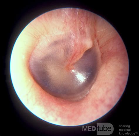 Normal Tympanic Membrane Light Reflex • Image •