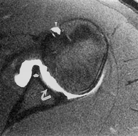 Aids To Successful Shoulder Arthrography Performed With A