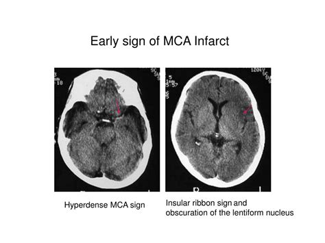 Ppt Neuroradiology Teaching Files Powerpoint Presentation Free