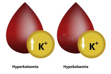 Hyperkalaemia And Hypokalaemia With Blood Shape Stock Illustration