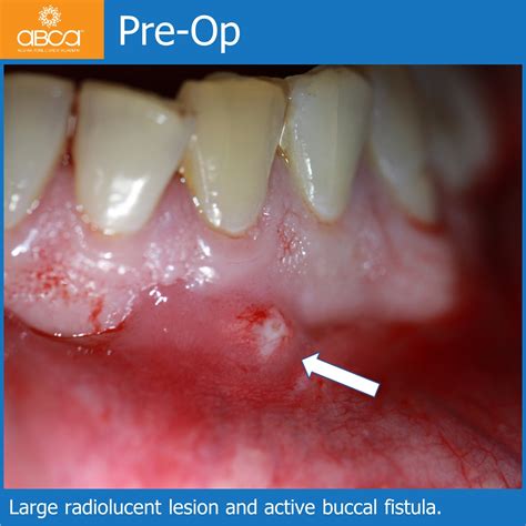Large Cyst Enucleation Apicoectomy With Mta Retrograde Filling And