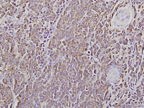 Pathology Outlines Kappa And Lambda Light Chains