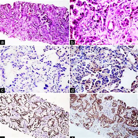 A And B Adenocarcinoma Showing Predominantly Lepidic Pattern With