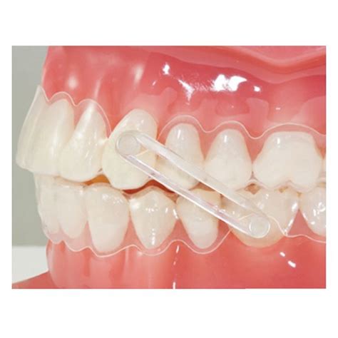 Role Of Elastics In Aligner Treatment Phialigner Knowledgebase