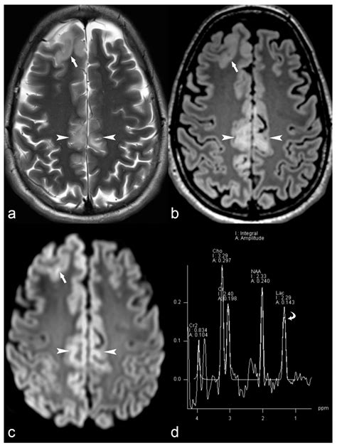 Morphological And Advanced Imaging Of Epilepsy Beyond The Basics