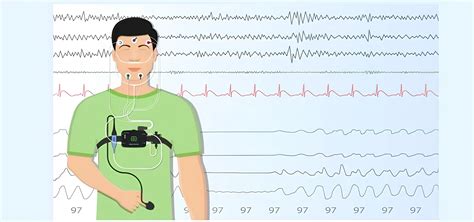 Level 1 Polysomnogram Sleep Study Accurate Sleep Diagnosis For Health