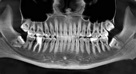 Wisdom Teeth Removal For Bite Correction In Dubai Polar Bear General Dental Clinic