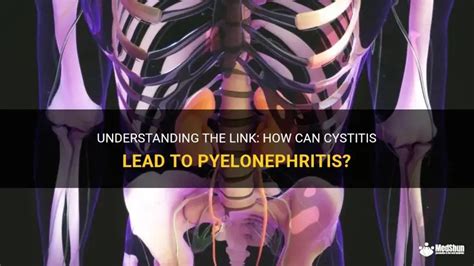 Understanding The Link How Can Cystitis Lead To Pyelonephritis Medshun
