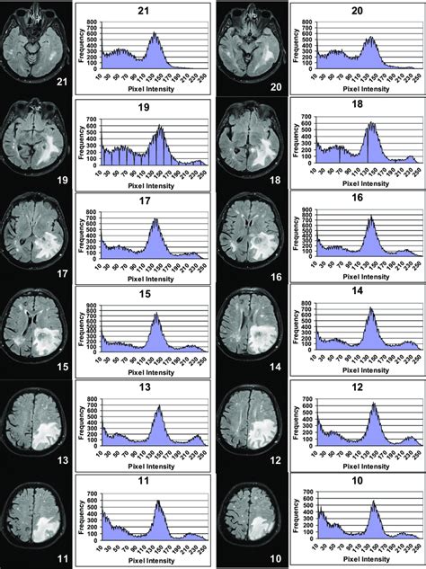 Flair Pulse Sequence Mri In The Transverse Plane Showing The Evolution