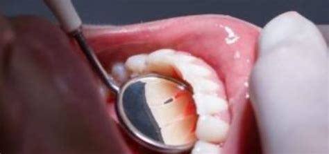 Tooth Pathology Dr Sunil Dental Blog