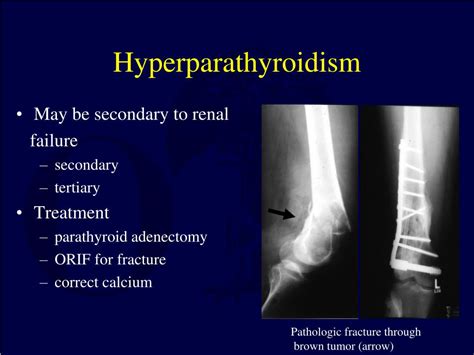 Ppt Pathologic Fractures Powerpoint Presentation Free Download Id