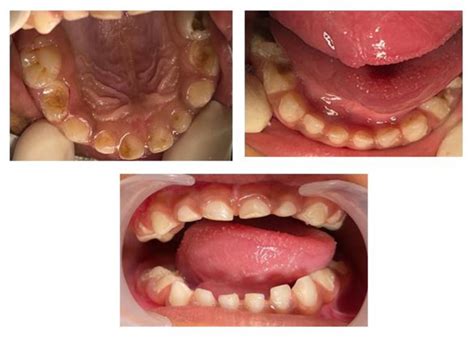 Intraoral Preoperative Photographs Showing Deep Occlusal Caries With